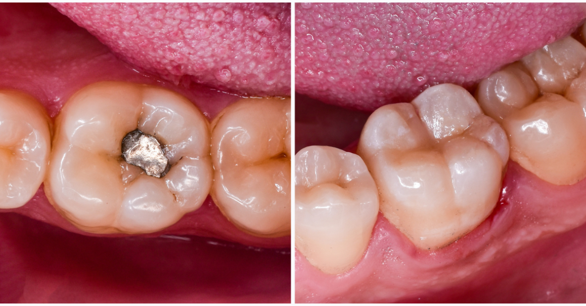 Understanding Different Types of Dental Fillings - sri sanjeevini dental